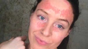 Elle se réveille avec le corps recouvert de plaques rouges: «J’ai du ...