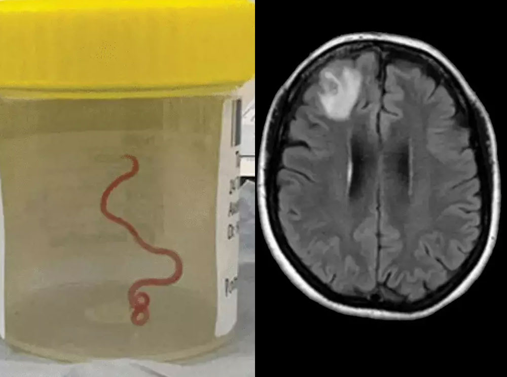 Un ver parasite vivant retiré du cerveau d'une femme pour la première ...